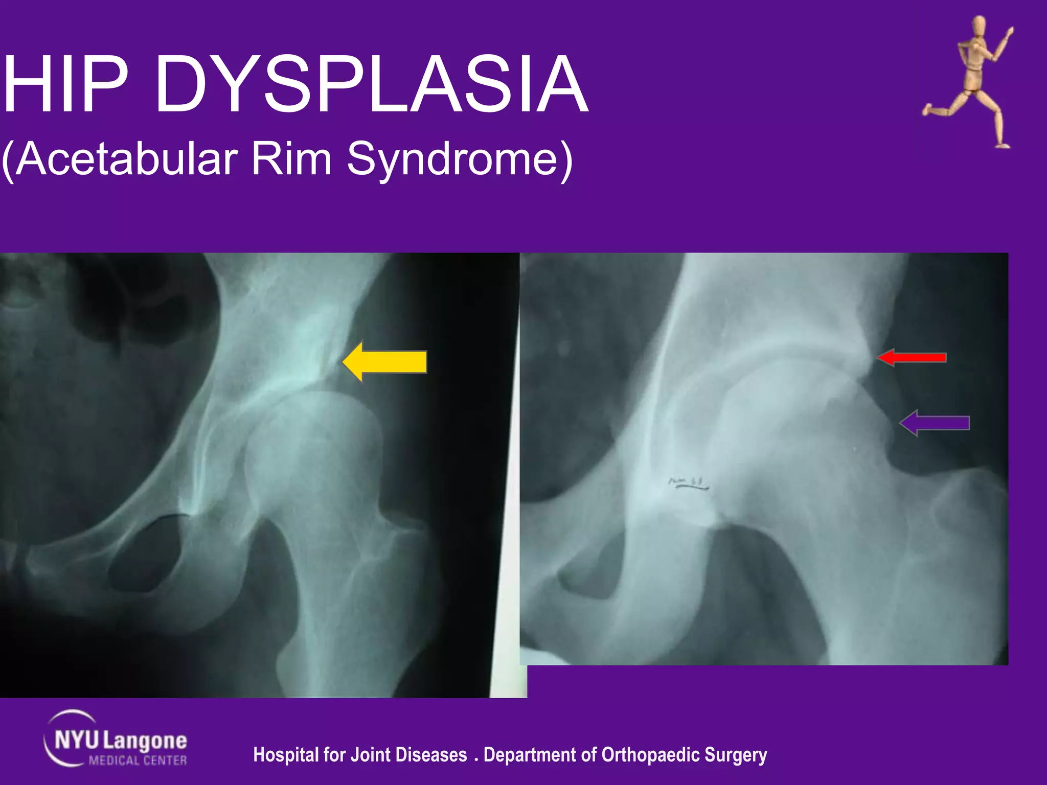 The Hip Joint in Cerebral Palsy | David S. Feldman, MD | PPTX
