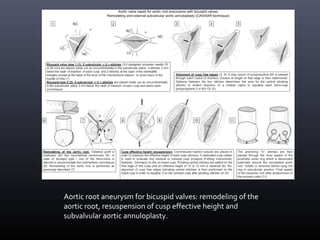 Aortic Valve Sparring Root Replacement | PPT