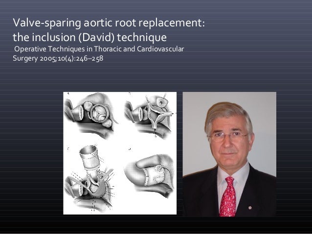 Aortic Valve Sparring Root Replacement
