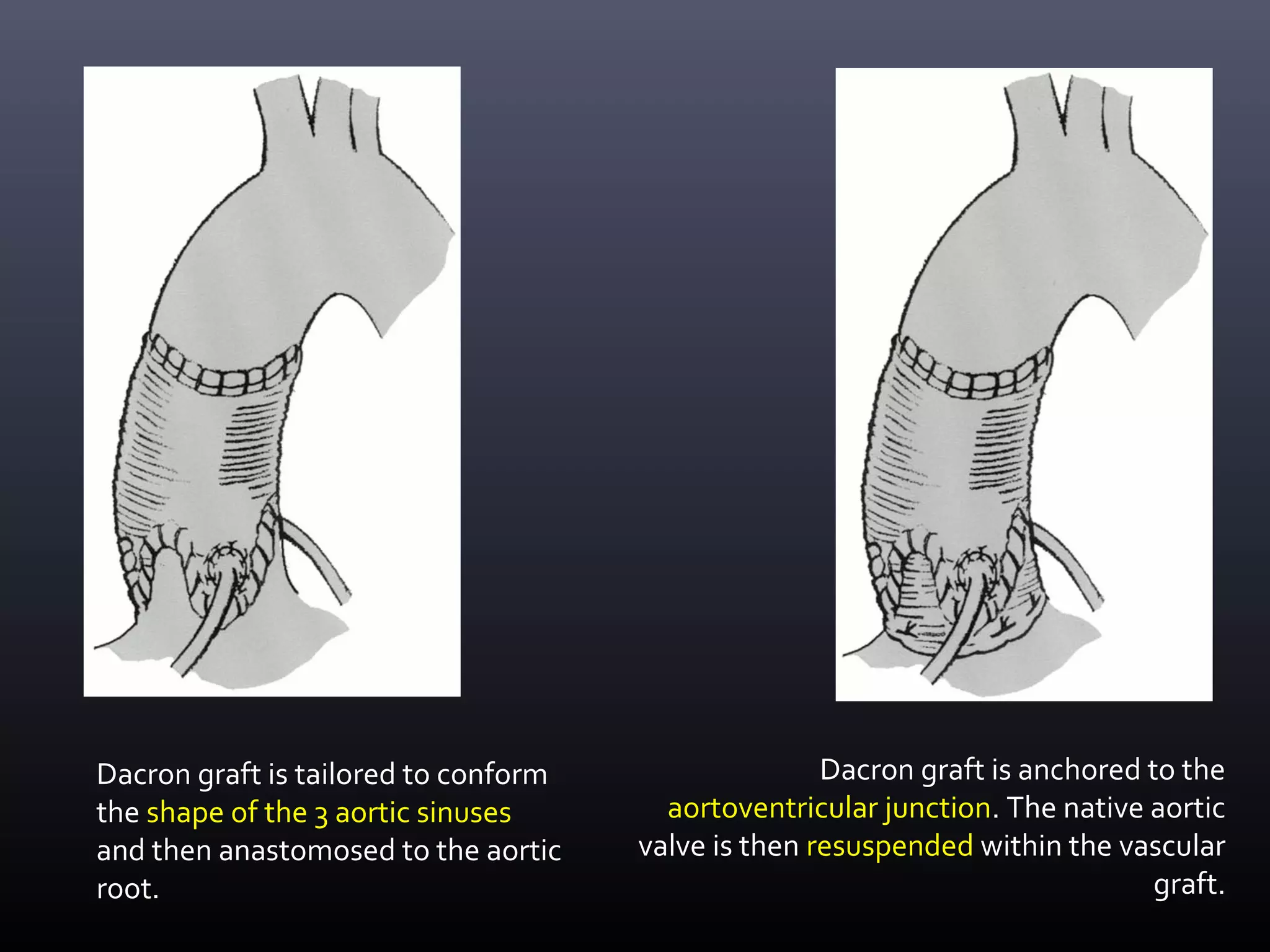 Aortic Valve Sparring Root Replacement David vs yacoub | PPT