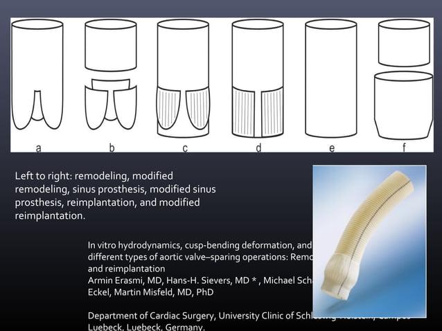 Aortic Valve Sparring Root Replacement David vs yacoub | PPT