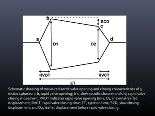 Aortic Valve Sparring Root Replacement David vs yacoub | PPT