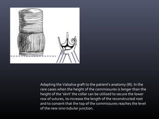 Aortic Valve Sparring Root Replacement David vs yacoub | PPT