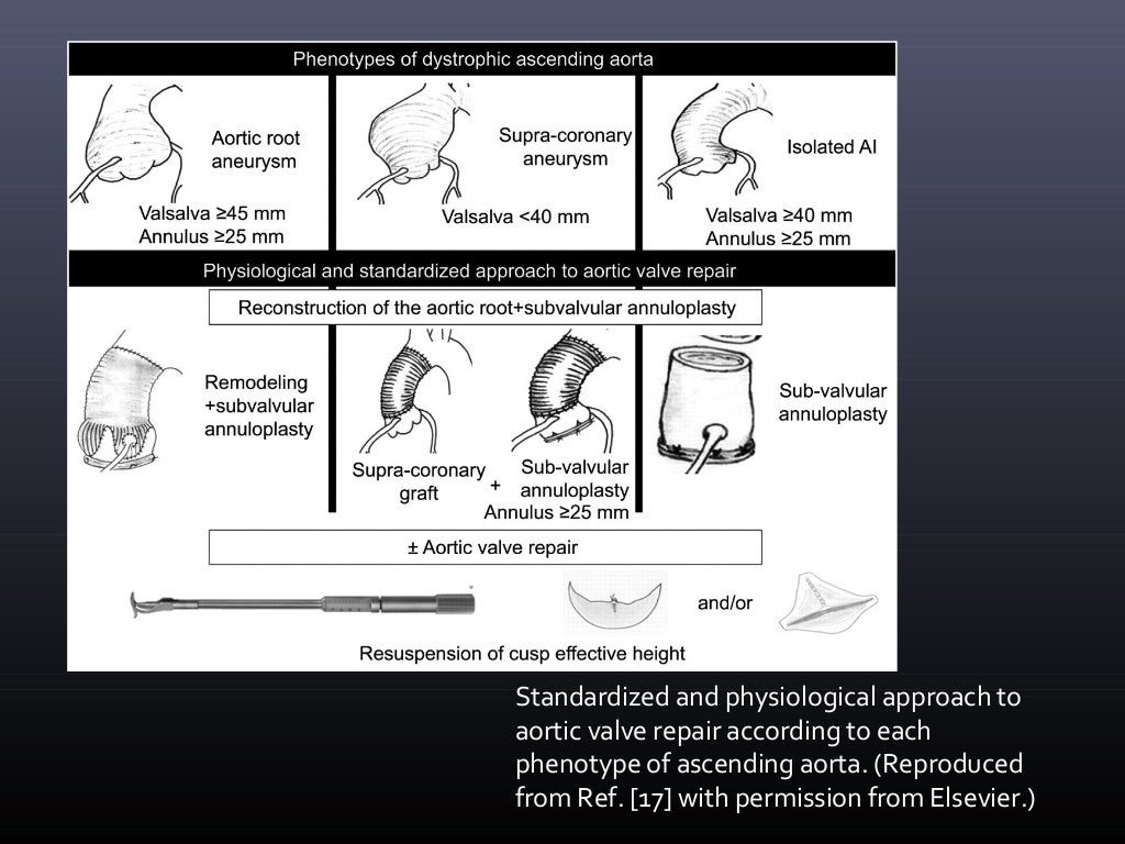 Aortic Valve Sparring Root Replacement David vs yacoub