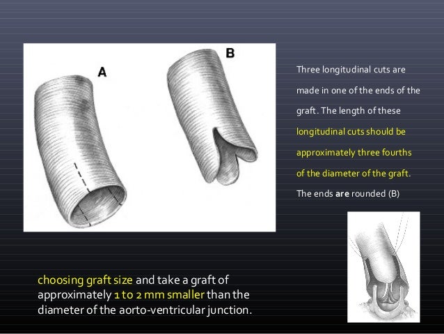 Aortic Valve Sparring Root Replacement David vs yacoub