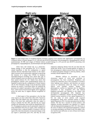 Acquired prosopagnosia: structural basis and processing impairments. | PDF