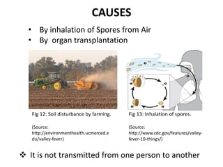 Cocciodioidomycosis by Davinder Singh | PPTX