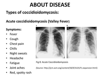 Cocciodioidomycosis by Davinder Singh | PPTX
