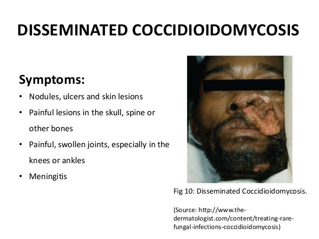 Cocciodioidomycosis by Davinder Singh