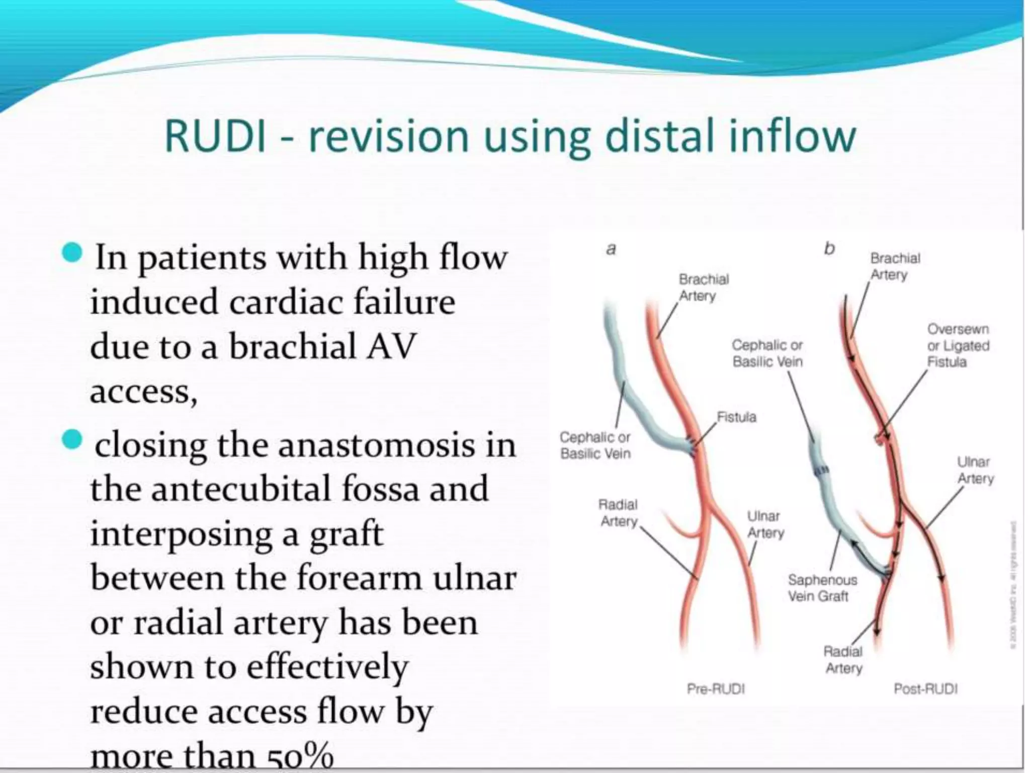 Surgery for avf complication | PPTX