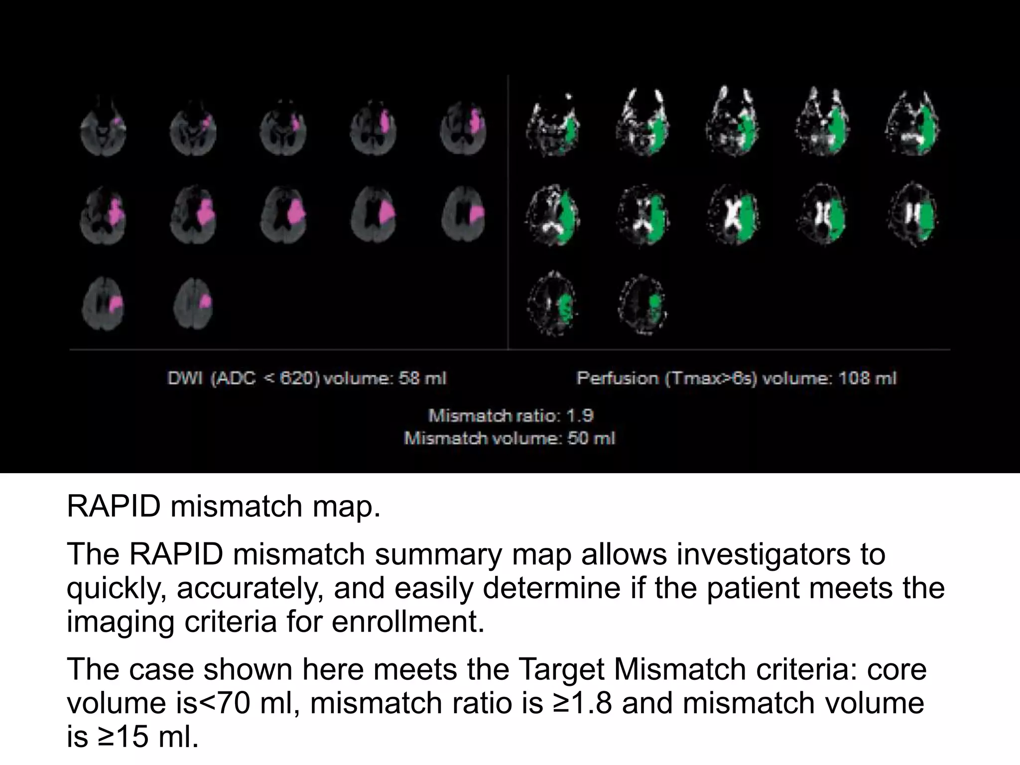 DAWN and DEFUSE 3 trial | PPTX