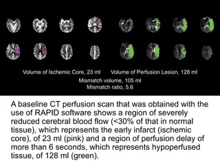 DAWN and DEFUSE 3 trial | PPTX