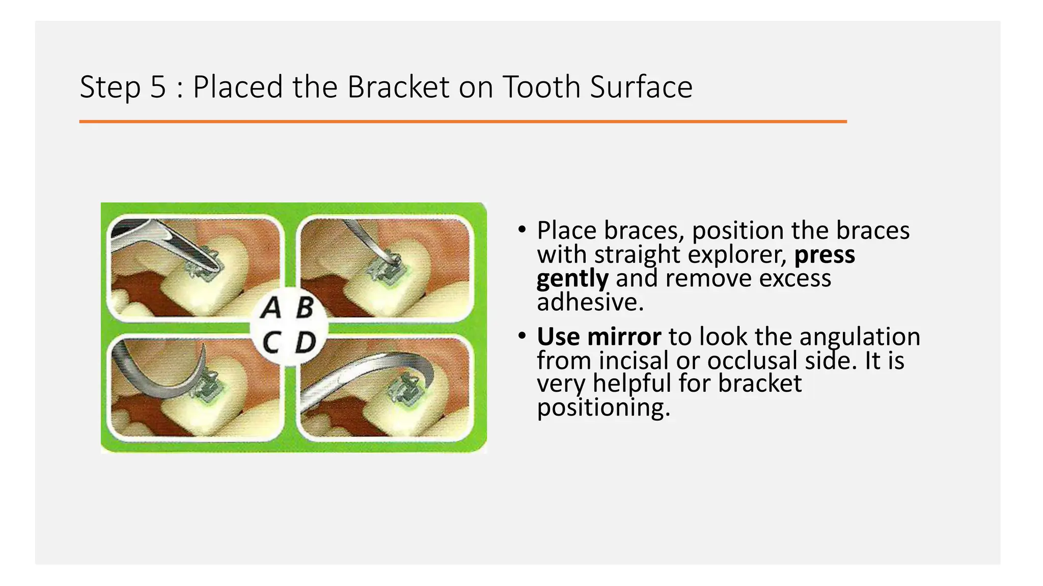 Day 2-2 2024 Step by step bracket placement pdf.pdf