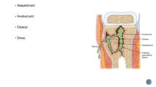 A brief review of osteomyelitis for board review | PPTX
