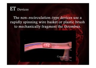 Endovascular_AVF | PPT