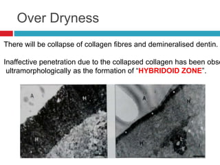 DENTIN BONDING AGENTS | PPTX