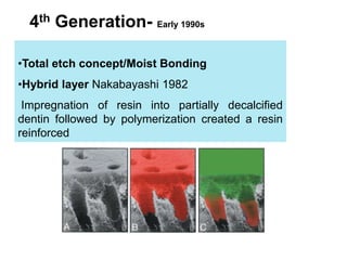 DENTIN BONDING AGENTS | PPTX