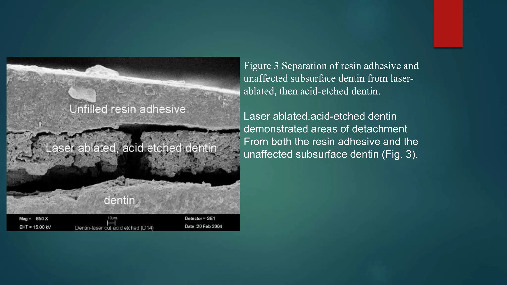 dentin bonding agents | PPTX
