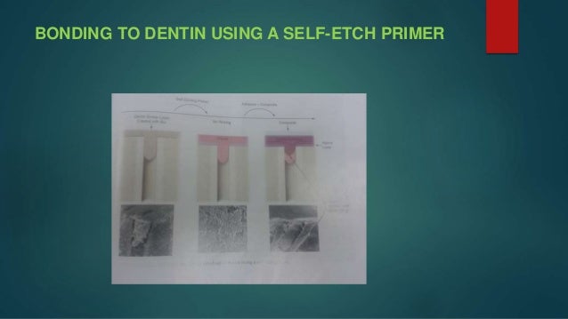 dentin bonding agents