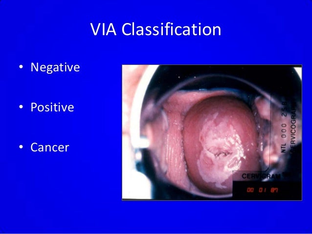 1 prof james bently cervical cancer screening 2014