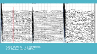 Multi-Modality Intraoperative Neurophysiologic Monitoring | PPT