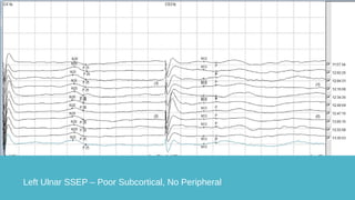 Multi-Modality Intraoperative Neurophysiologic Monitoring | PPT