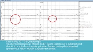 Multi-Modality Intraoperative Neurophysiologic Monitoring | PPT