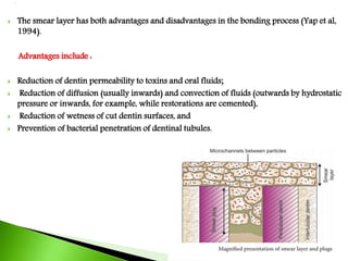 Dentin bonding agents sneha | PPTX
