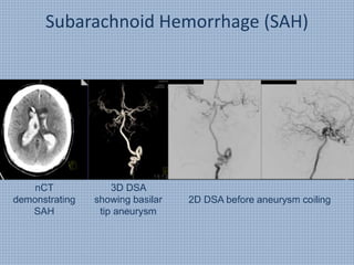 Introduction to Neuroendovascular Surgery | PPTX