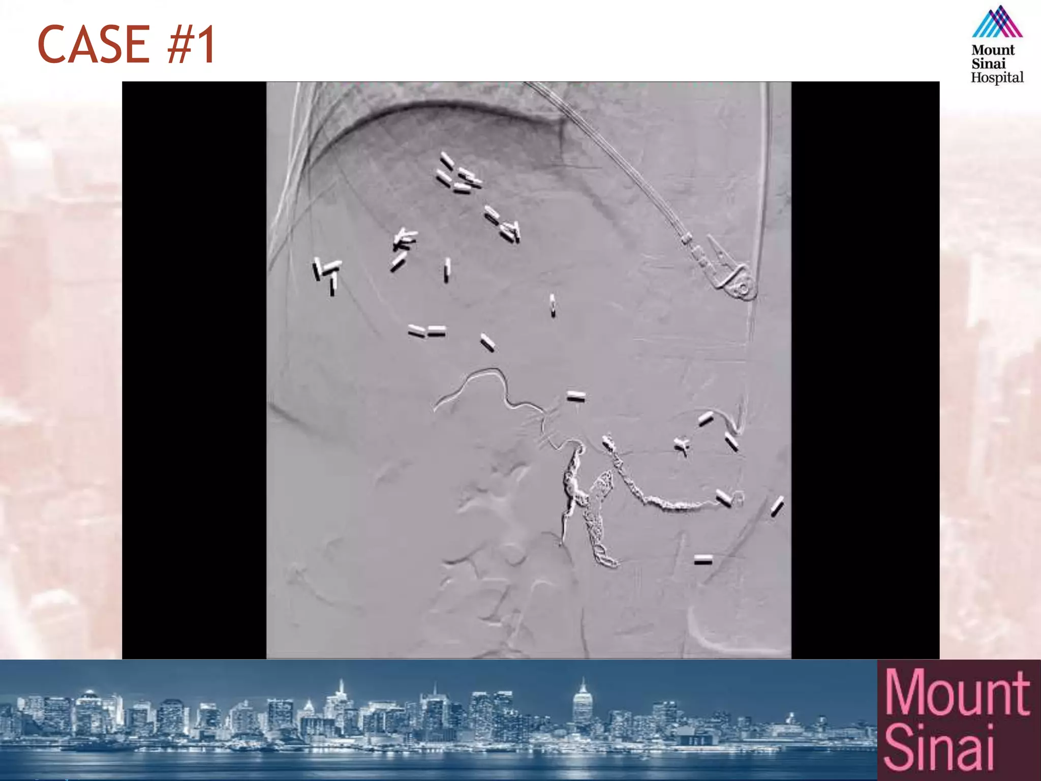 Biederman DM - AIMRADIAL 2014 Endovascular - Surefire catheter | PPTX