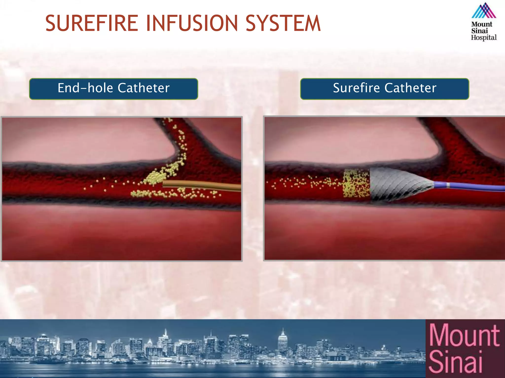 Biederman DM - AIMRADIAL 2014 Endovascular - Surefire catheter | PPTX