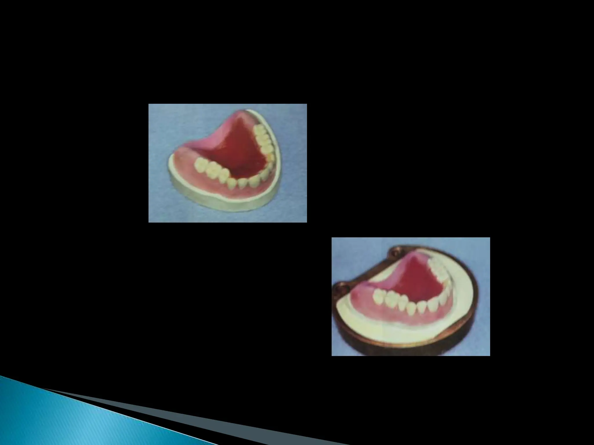 Denture base materials in removable denture | PPTX