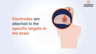 Deep Brain Stimulation for Parkinson's disease | Treatment at Yashoda Hospitals | PPTX