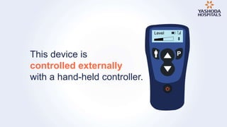 Deep Brain Stimulation for Parkinson's disease | Treatment at Yashoda Hospitals | PPTX