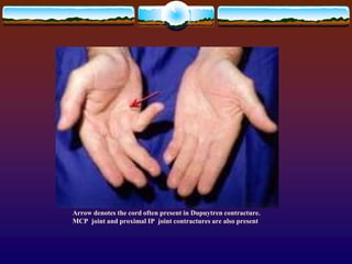 Dupuytren's Contracture | PPT