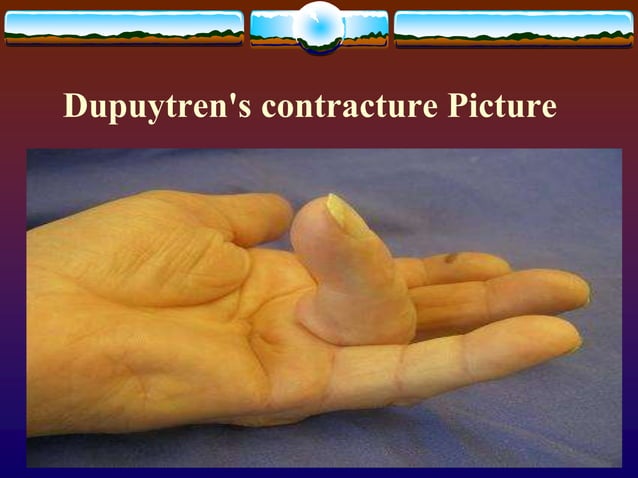 Dupuytren's Contracture | PPT | Medical Health