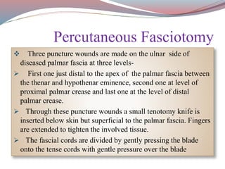 Dupuytren's Contracture By Ansarul Haq | PPTX