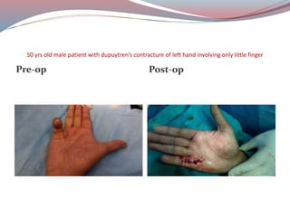Dupuytren's Contracture By Ansarul Haq | PPTX | Injuries | Diseases and ...