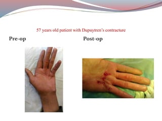Dupuytren's Contracture By Ansarul Haq | PPTX | Injuries | Diseases and ...