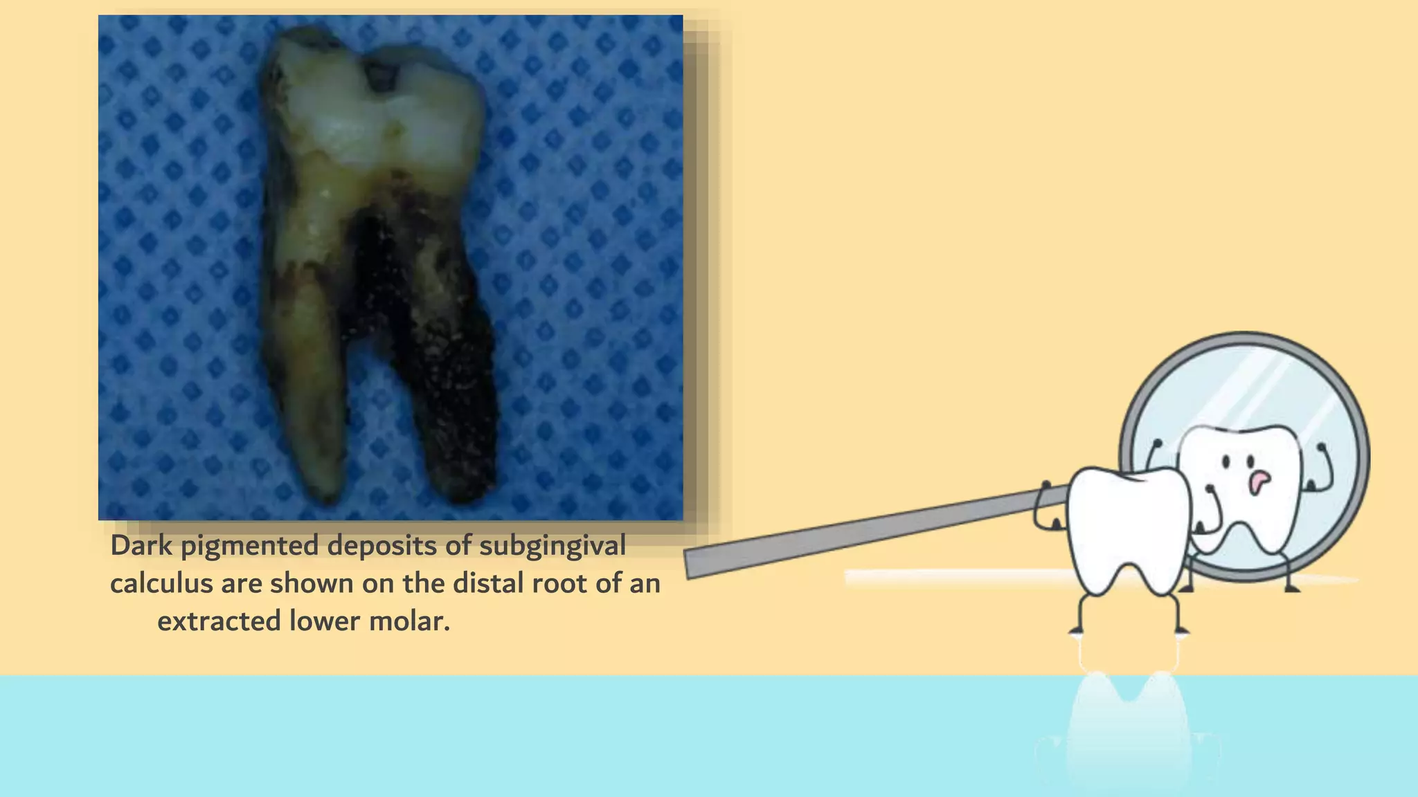 Dental Calculus.pptx