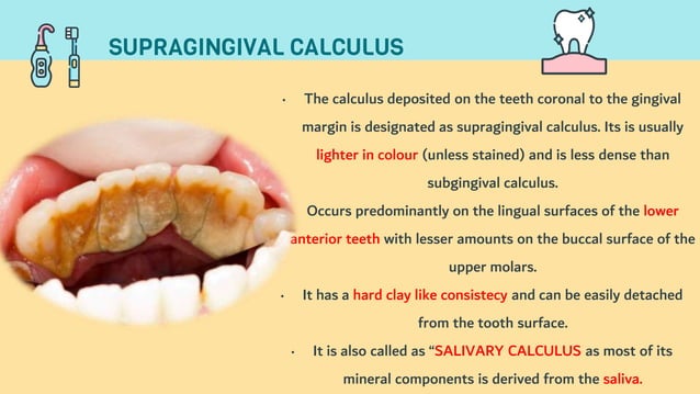 Dental Calculus.pptx | Dental Health | Diseases and Conditions