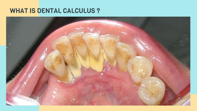 Dental Calculus.pptx | Dental Health | Diseases and Conditions