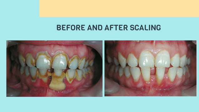 Dental Calculus.pptx | Dental Health | Diseases and Conditions