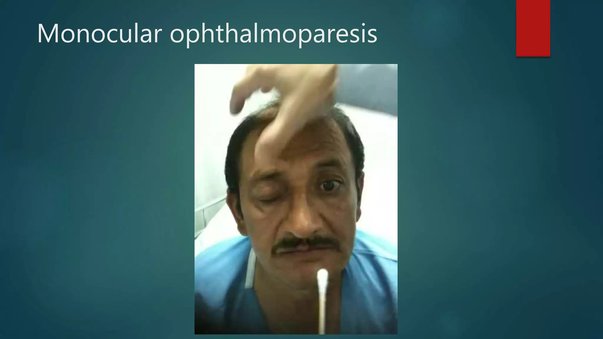 A Case of Painful Ophthalmoplegia | PPTX