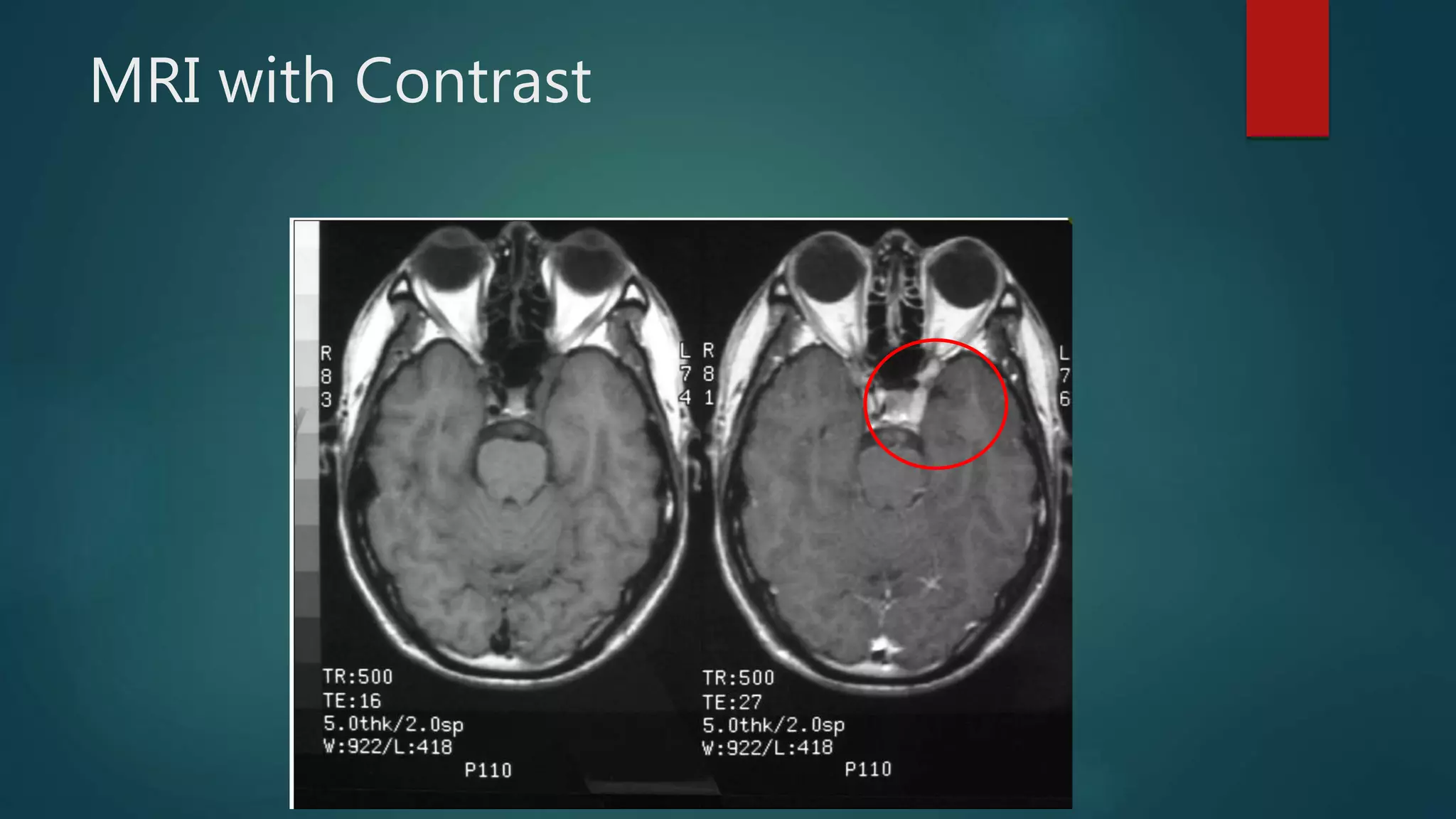 A Case of Painful Ophthalmoplegia | PPTX