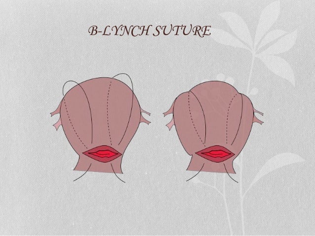 my ppt SURGICAL MANAGEMENT OF PPH