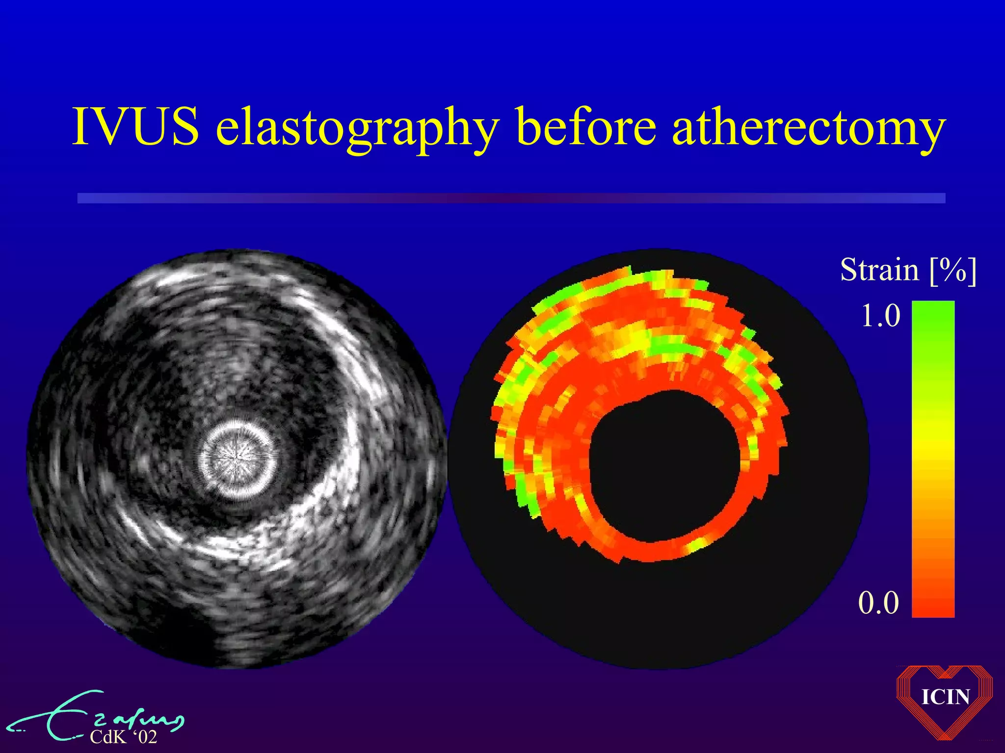 145 intravascular elastography | PPT
