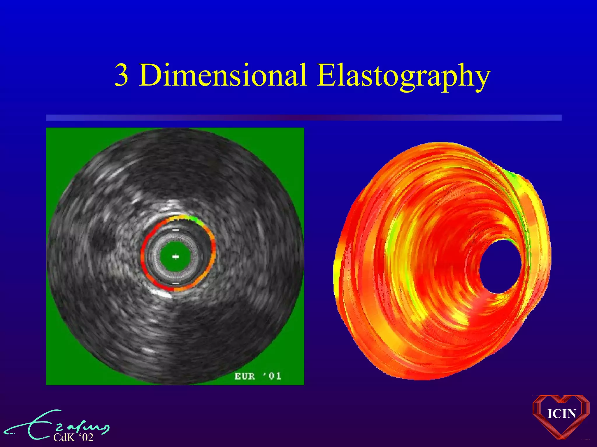 145 intravascular elastography | PPT