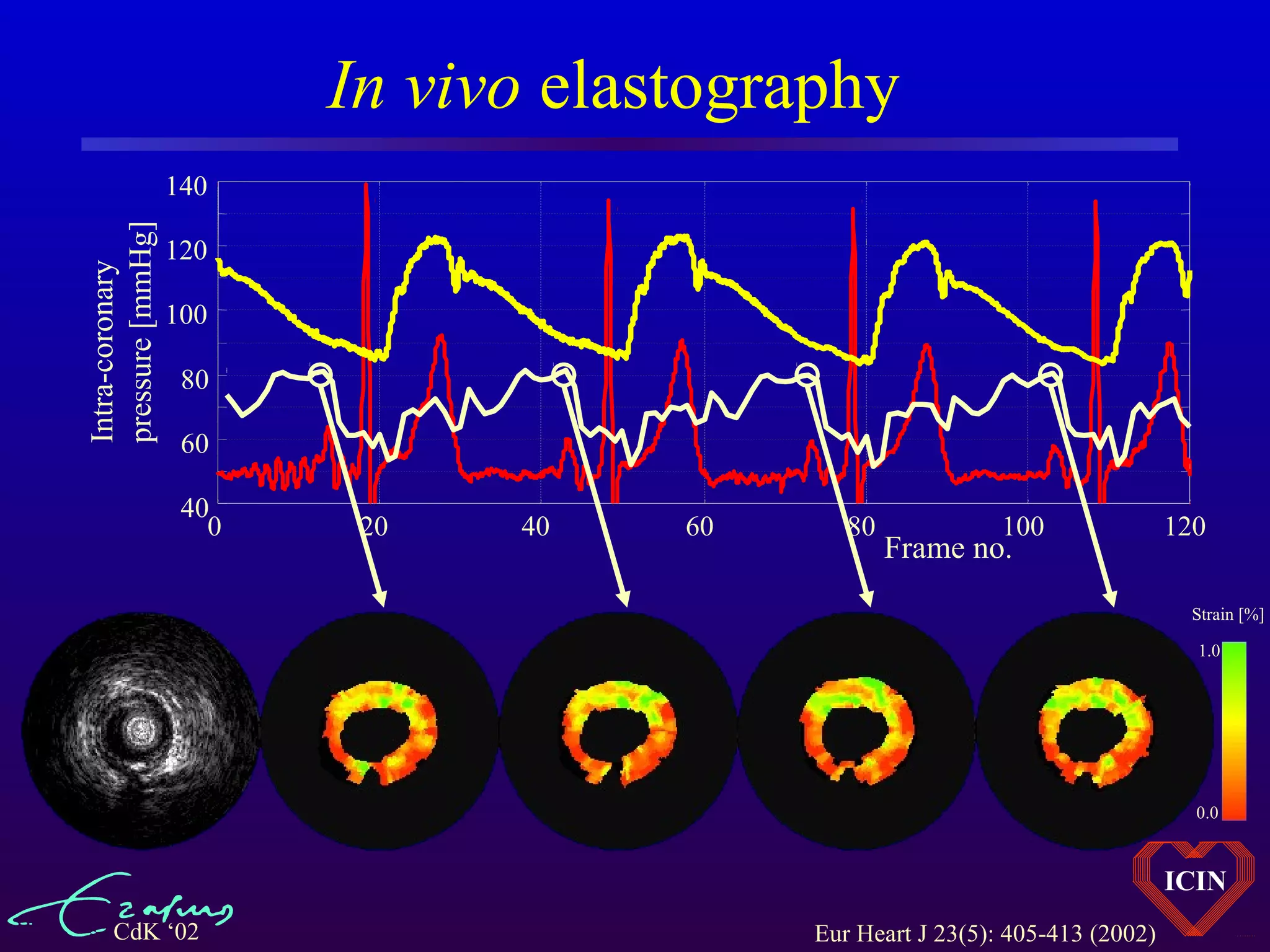 145 intravascular elastography | PPT