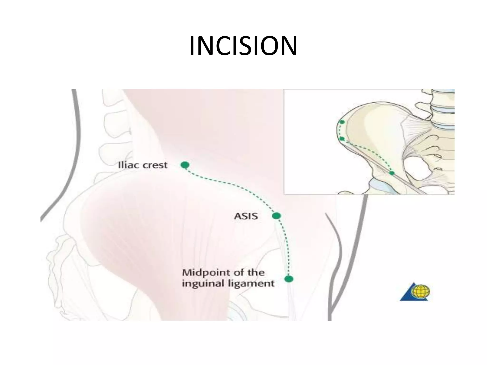 Deep circumflex iliac artery flap | PPTX